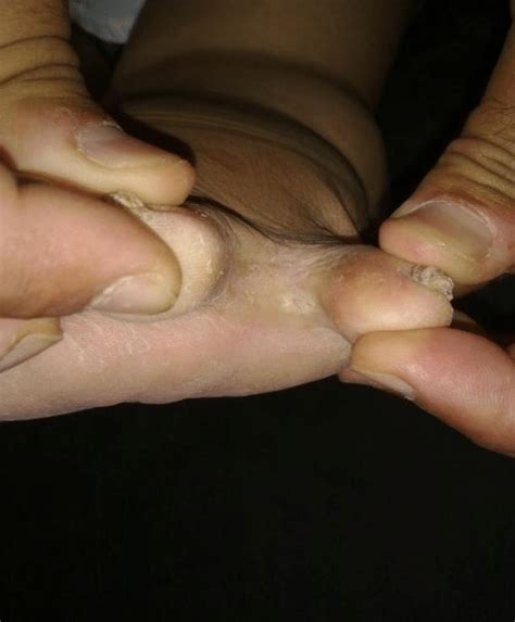 Tinea Pedis A 4 Th Interdigital Space Before Showing White Scales Download Scientific