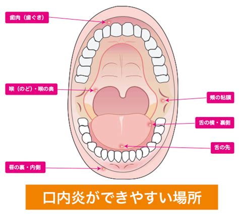口内炎の原因と治し方、歯科や医科の受診について 枚方市楠葉・枚方くずはアップル歯科