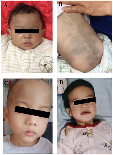 Frontiers Asxl3 Gene Variants Causing Bainbridge Ropers Syndrome