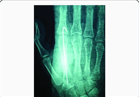 2 Nd Metacarpal Fracture Managed By K Wire Fixation Download Scientific Diagram