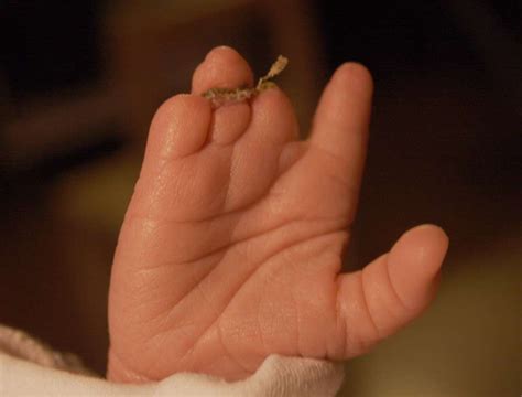 Birth Defects Dr Ashish Gupta