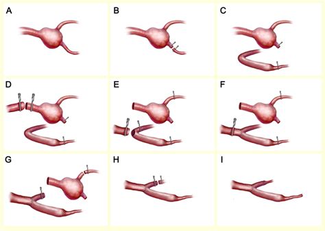 Strategy Patterns Of Trimmed V Shaped Applied To Bifurcation Aneurysms