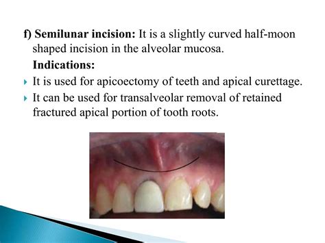 Incisions In Head And Neck Region Pptx