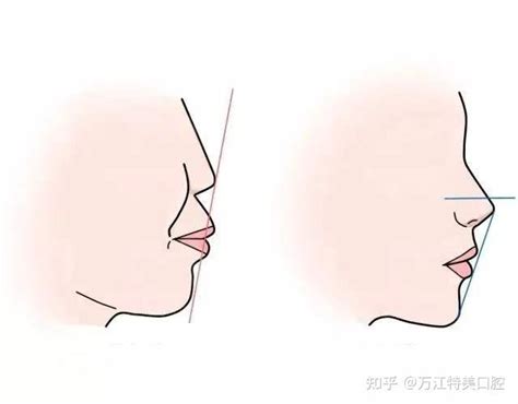 整牙后嘴凸的要命，为什么正畸越整嘴越凸后期会好吗？ 知乎