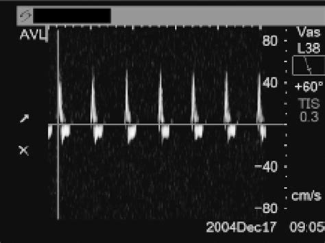 Reverberating Flow Pattern In Vertebral Artery Download Scientific Diagram