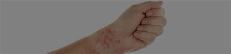 True Test Patch Testing For Contact Dermatitis Diagenics