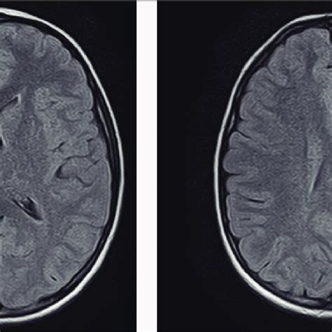 T2 Flair Mri Images Showing No Lesions At 10 Years Of Follow Up