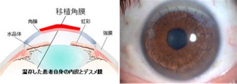 角膜移植 溝上眼科