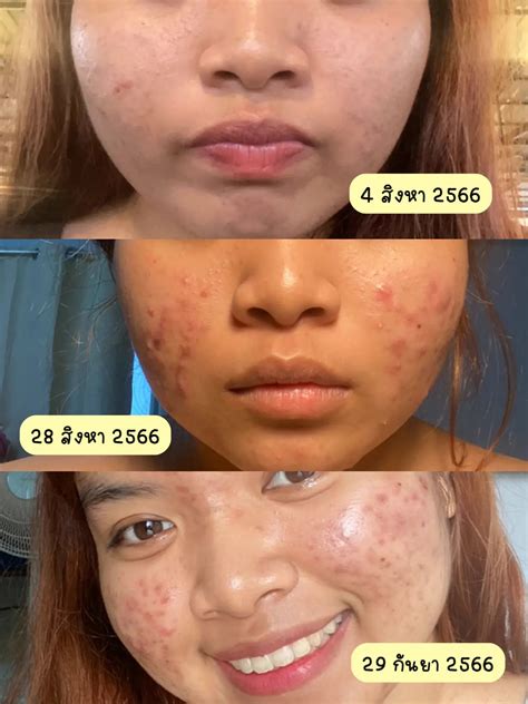 รักษาสิวด้วยตัวเองแบบ 300 ในเวลา 3 เดือน แกลเลอรีที่โพสต์โดย พอยพอย 🍅