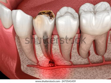 Periostitis Tooth Lump On Gum Above Stock Illustration 2473541459
