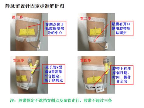 践行静疗规范保障输液安全 药液