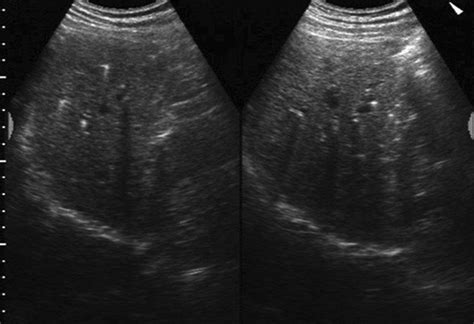 Cholangitis Ultrasound