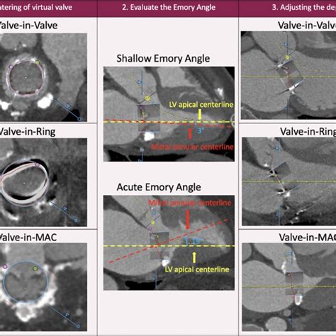 Assessment Of Left Ventricular Outflow Tract Lvot Obstruction Risk