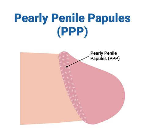 Pearly Penile Papules Wat Zijn Dat Simptonl