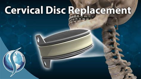 Artificial Cervical Disc Replacement Shimspine