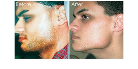 Physician Laser Center Annapolis Laser Hair Removal
