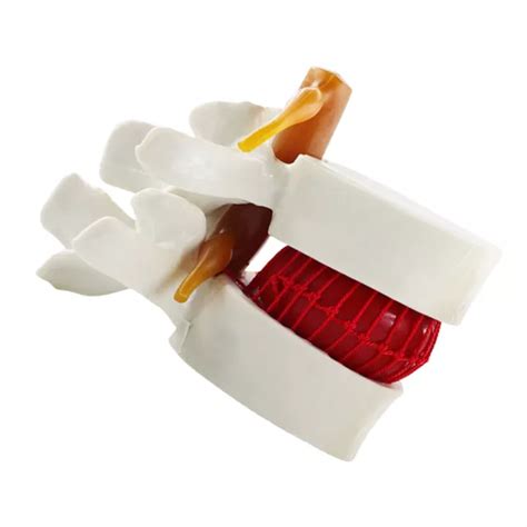Intervertebral Disc Model Pvc Lumbar Spine Herniation Teaching £19 89