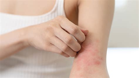 Dietary Vitamin E May Be Protective Against Atopic Dermatitis Dr