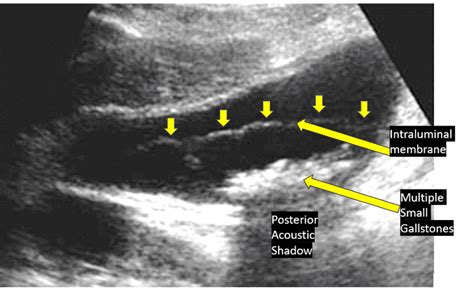 Role Of Point Of Care Ultrasound Pocus In Diagnosing Gallstones And
