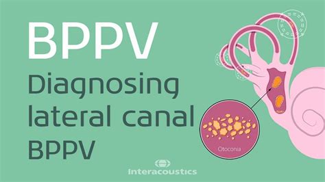 Horizontal Canal Repositioning Maneuver