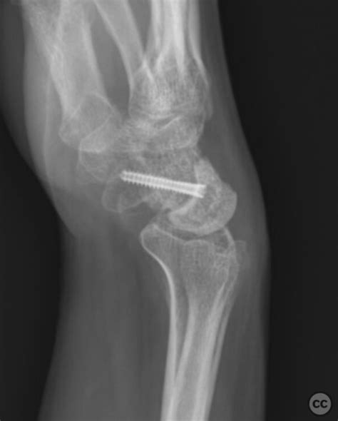 Scaphoidectomy And Four Corner Arthrodesis