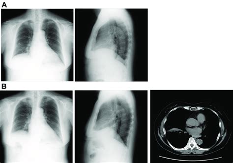 A Chest Radiographs Of Posterior Anterior View Left And Right Left