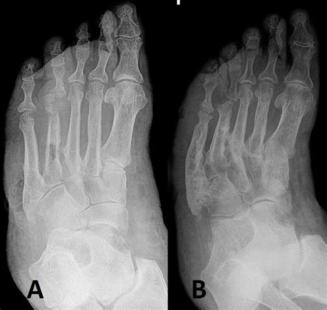 Ulcers Arterial Neuropathic Venous Teachmesurgery
