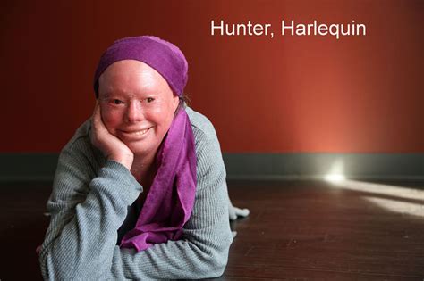 Ichthyosis Harlequin Positive Exposure