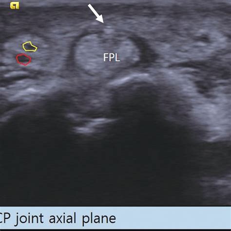 A Sagittal View Of The A1 Pulley In The Right Thumb Arrow Indicates