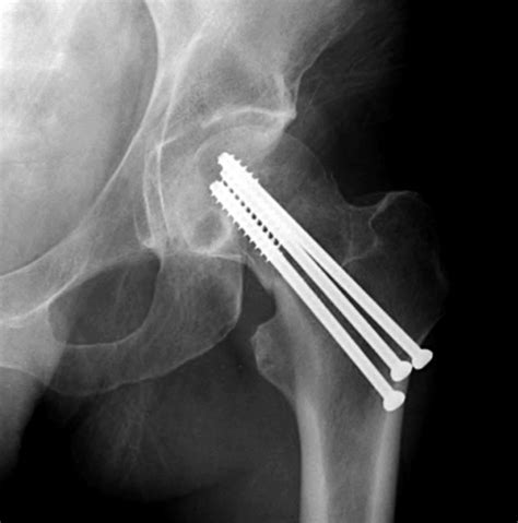 Fracture Fixation A Gallery