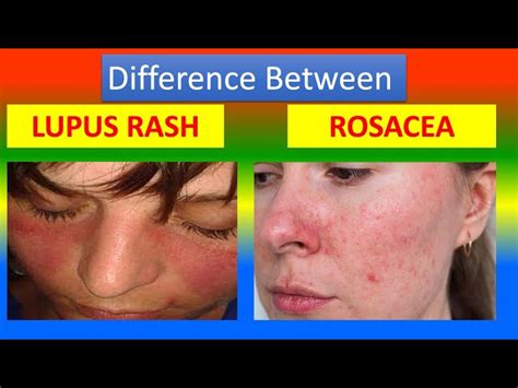 Butterfly Rash Vs Malar Rash