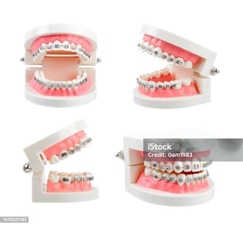 흰색 배경에 격리된 금속 와이어 치과 교정기 또는 치과 기구가 있는 치아 모델 세트 클리핑 경로 저장 0명에 대한 스톡 사진 및 기타 이미지 Istock