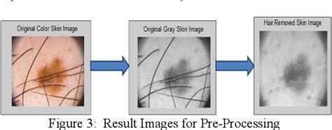 Figure From A Method For Melanoma Skin Cancer Detection Using Dermoscopy Images Semantic Scholar