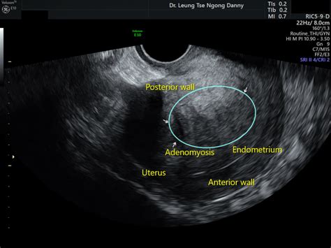 Adenomyosis Hkog Info