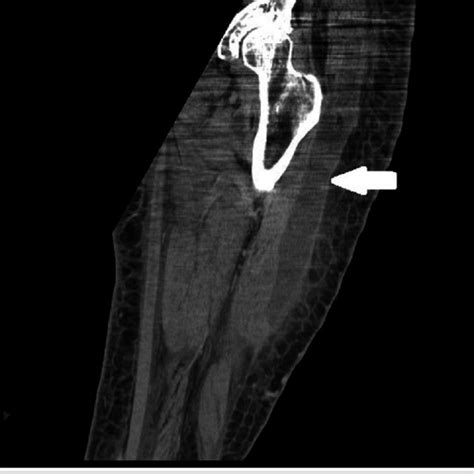 Pdf Necrotizing Fasciitis A Life Threatening Complication Of Intraoperative Electromyography