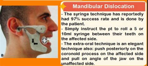 Mandibular Dislocation