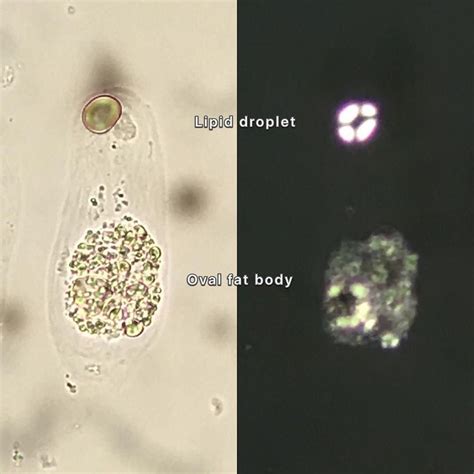 Fat Droplet In Urine Microscopy