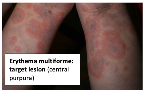 Clinical Practice Guidelines Urticaria