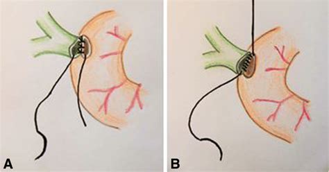 Continuous Or Interrupted Suture Technique For Hepaticojejunostomy A National Survey Springerlink