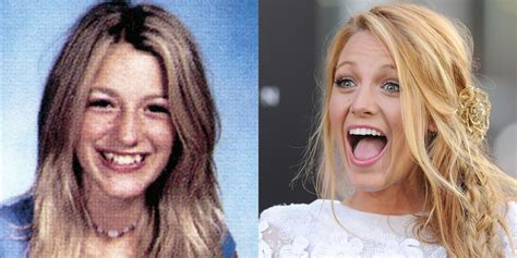 10 Celebs We Totally Forgot Had Their Teeth Fixed