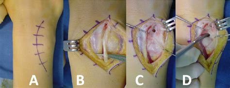 A Open Surgery For Tfcc Type 1b Lesion Repair A Skin Incision