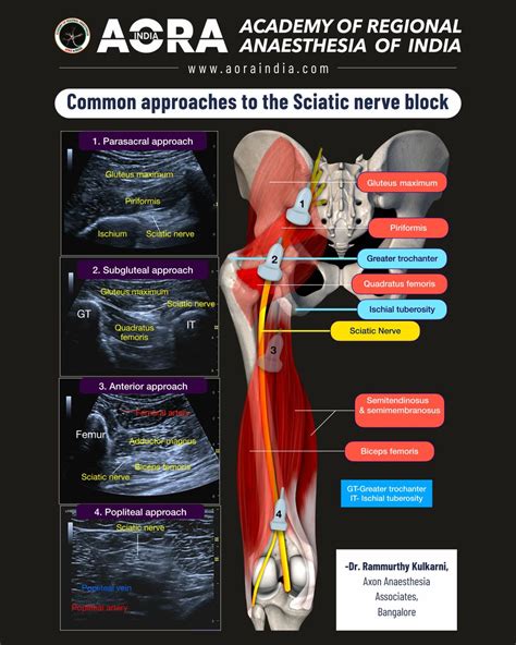 Sciatic Nerve Block Anterior Approach
