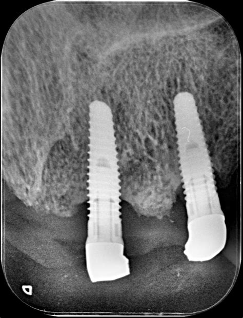 Recognize And Locating Old Imz Screw Implant Implant Detective
