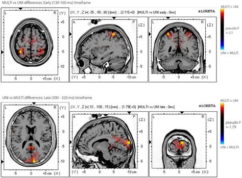 Sloreta Source Localisation Sloreta Statistical Image Showing