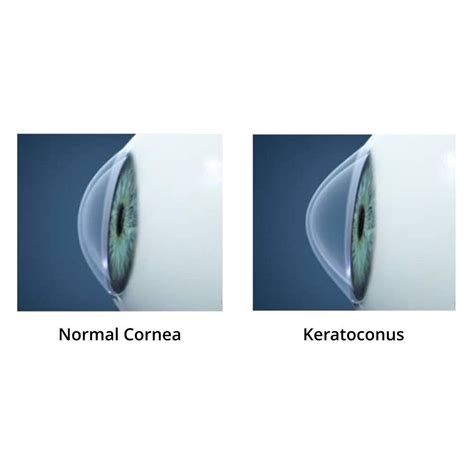 What Is Keratoconus Rosewall Mccarthy Optometrists