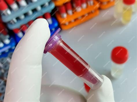 Hemolyzed Sample Chloride At Evelyn Lowman Blog