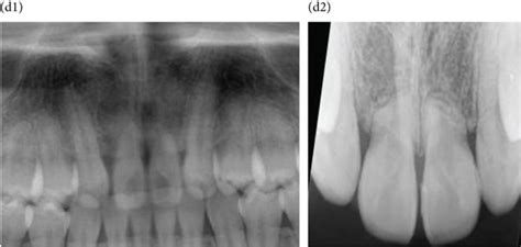 Panoramic Radiograph Revealing Root Resorption Of Maxillary Incisors