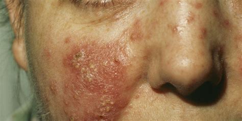 Could You Have Rosacea—or Is Your Skin Just Red Womens Health