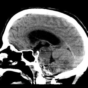 Noncontrast Computed Tomography CT Brain Sagittal View With