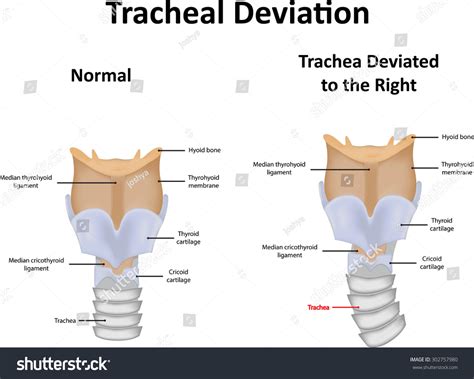 What Is Tracheal Deviation At George Redden Blog